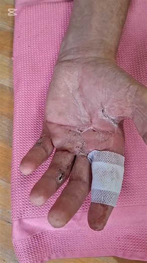 Andrea Moser | Finger flexion made simple ✨ This exercise splint + rolling tool turns repetition into progress. 🎯 Clear target, easy movement, effective... | Instagram