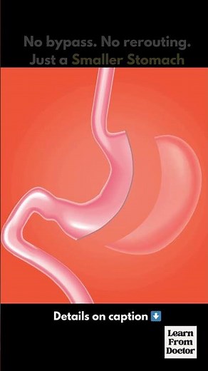 Vertical Sleeve Gastrectomy (VSG) Explained | How Sleeve Surgery Works Inside the Stomach