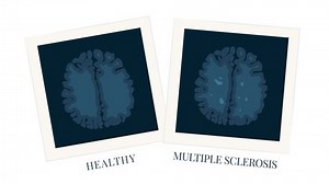 Multiple Sclerosis Motion Graphics Mri Scan Stock Footage Video (100% Royalty-free) 1042000267 | Shutterstock