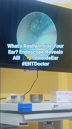 What’s Really Inside Your Ear? Endoscope Reveals All! 🔬👂 #InsideEar #ENTDoctor