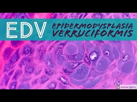 Epidermodysplasia verruciformis (EDV) 101