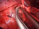 Uniportal VATS Removal of an Intrabronchial Chicken Bone with Bronchial Reconstruction • Video • MEDtube.net