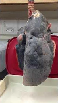 Blowing up human lungs (smoker's lungs) AP 120