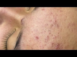 ASMR extreme deep cleansing asmr | acne & blackhead removal #asmr