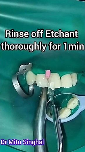 STEP BY STEP Dental filling: Composite Light -cure filling procedure explained