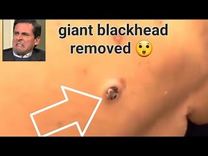 Pimple POPPING video//Giant sebaceous CYST//Must see! #blackhead #sebaceouscyst