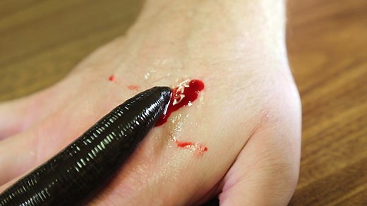 Why you shouldn't salt a leech that's sucking your blood | CBC News