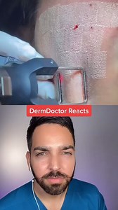 laser fun #dermdoctor #co2laser #acnescars #doctorly #dermotologist | Dr. Muneeb Shah
