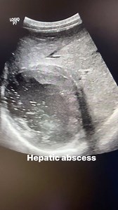 Hepatic abscess #liverabscess #hepaticabscess #ultrasoundmadeeasy | Ultrasound made easy