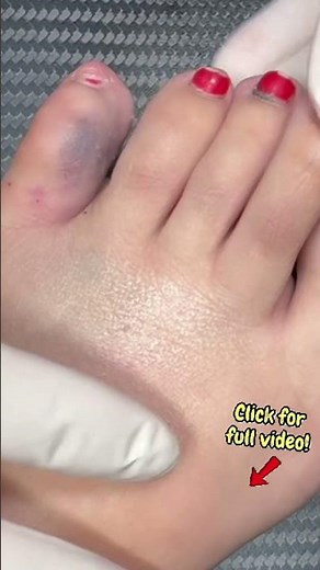 Toe Fracture or Dislocation? Try Guessing First 👀 #satisfying #footcare