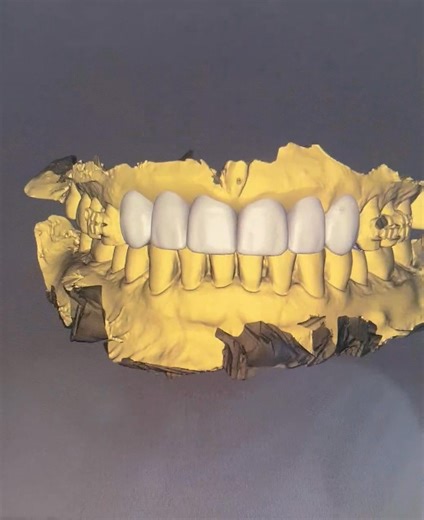 Diagnostic wax up I designed for one of my doctors! Using it as a reference to show the patient their new teeth. 🤩 🦷#inlab #designing #anteriorrestorations #dentaltechnician #digitaldentistry | Franklin Dental Lab, LLC