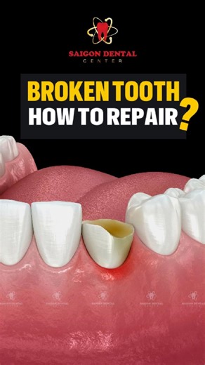 Broken Front Tooth? Here’s How Dentists Fix It Fast! #brokentooth #dentalimplants #immediateimplant #implantcenter | NHA KHOA SÀI GÒN - Dental Implant Center