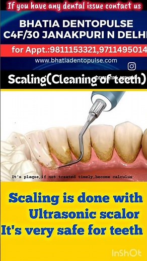 See how scaling (Cleaning of teeth is important) Plaque removal l ultrasonic scaling #scalingofteeth