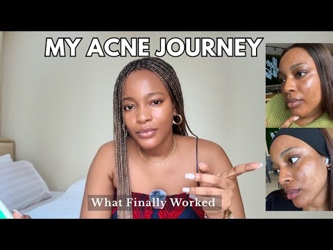 How I Manage Acne: My Skincare Routine + Best products that work!