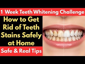 How To Remove Teeth Stains at Home | How To Remove Tartar From Teeth | Teeth Whitening