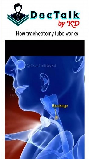 How tracheotomy tube works #tracheotomy Life saving medical procedures #medicalprocedure #trachea