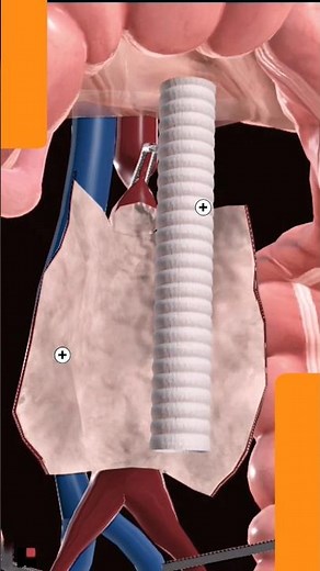 "Abdominal Aortic Aneurysm Repair :A Life Saving Surgery "#AAA Repair.