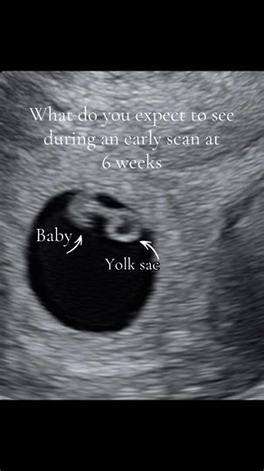 Expecting an Early Pregnancy Scan at 6 Weeks