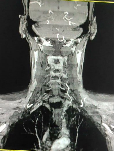 MRA Neck Vessels #radiology #medicalimaging #mri #angiography #neck