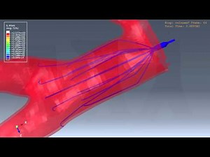 Virtual IVC Filter Placement: Simulation Steps