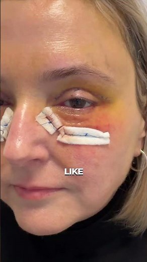 7-Day Post-Surgery Update: Endoscopic Brow Lift + Quad Blepharoplasty with Fat Repositioning