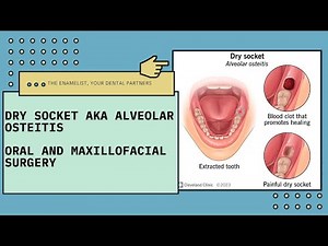 Dry Socket | Alveolar Osteitis | Oral And Maxillofacial Surgery
