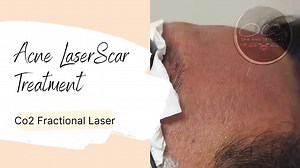 Mother’s Day Beauty Treats Co2 laser Treatment * For Deep Acne Scars * Fine Lines Buy 1 take 1 “Hugis Bigas” Combo Package 7D HIFU RF for younger “Hugis Bigas” face 5000php 3 sessions MicroNeedling Package 6 sessions Unlimited UA Laser Hair Removal Treatment 6 sessions Bleaching 6 sessions Picolaser Whitening 7,500php only 6 sessions Brazilian Laser Hair Removal Treatment 6 sessions Bikini Bleaching 6 Session Picolaser whitening 8,500php only Message us for Inquiries Oli’s Spa and Skin Care | Ol