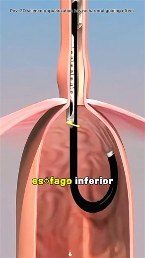 How Incisionless Fundoplication Surgery Is Performed (3D Animation)#endoscopicsurgery#gerd