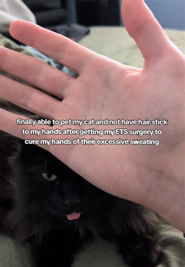 ETS surgery is a game changer when it comes to hands sweating excessively 💧🖐🏼 Schedule a free phone consultation with us via our link in bio, website, or by calling directly us at 310-557-3037. #hyperhidrosis #excessivesweating #sweatyhands #sweat #community