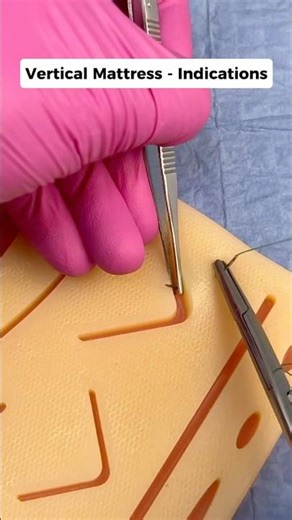 When to Use a Vertical Mattress Suture 🔥 #pastudent #npstudent #howtostitch #stitches #howto