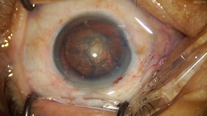 Four-Incision Phaco Chop and Other Phaco Complications - Eyetube