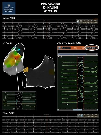 PVC ablation originating from the right ventricular outflow track Dr Franck Halimi Rythmologue Paris