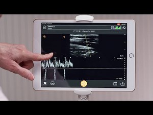 Clarius Feature: Pulsed-Wave Doppler Mode