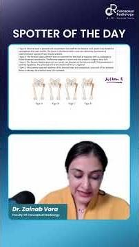 Spotter Quiz: Proximal Focal Femoral Deficiency (PFFD) Type A | Dr. Zainab Vora #shorts