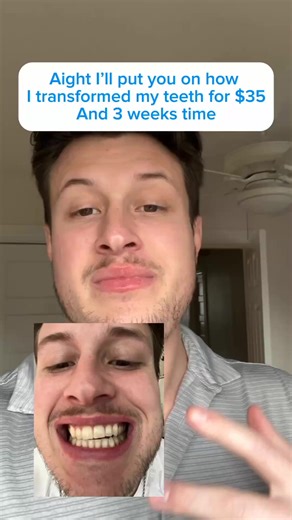 The secret to a dazzling smile? ✨ Snow Diamond Dissolving Whitening Strips! These mess-free, no-rinse strips dissolve in minutes, whitening your teeth effortlessly. No trays, no hassle—just a brighter smile on the go! #dentistry #SmileHealthy #oralhygiene #FreshBreath | SNOW Teeth Whitening | Facebook