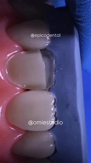 Composite restoration teeth. Composite veneers. #dentist #dental #smiledesigndental