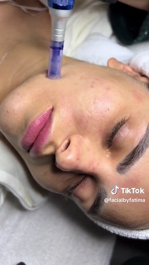 Got so many questions about our dermapen session steps🤍 ✨Experience the benefits of improved blood flow, increased lymphatic drainage, and a boost in collagen production, as your skin embraces a renewed vitality. ✨ #facial #dermapen #dermapentreatment