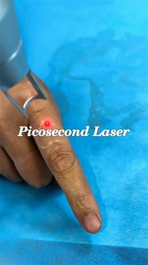 Testing picosecond laser on an old tattoo 👀 Watch how the ink reacts in seconds—it turns white for a moment! ⚡ Have you ever tried laser tattoo removal before? #laser #tattooremoval #beautytech #beautydevice #trending | Amelia Clinton