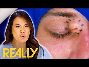 Dr. Lee Removes A Dangerous Cyst Near Patients Orbital Socket l Dr Pimple Popper