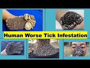 Tick Humans worse infestation in history