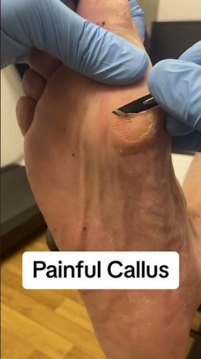 Epic Callus Removal Transformation by Podiatrist: Watch the Scalpel Magic! #FootCare #BeforeAfter