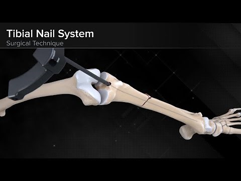 Tibial Nail System—Standard Surgical Technique