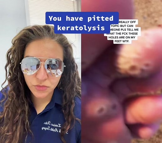 #duet with @drpimplepopper I love her… but I respectfully disagree; it’s warts and pitted keratolysis. I’ll never have a TLC show now… maybe discovery channel. #drpimplepopper #gross #feet #podiatristexplains #drlala #dallasfootdoctor #footpain #feet #MakeNightsEpic #dueto #dermatology #hyperhidrosis