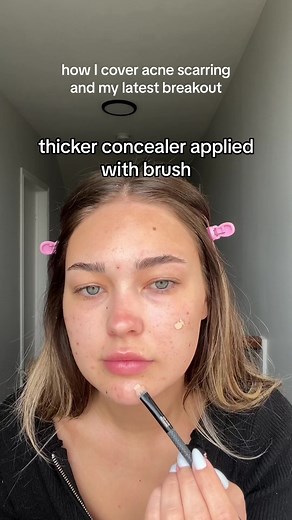 Covering Acne Scars with Makeup: A Step-by-Step Tutorial