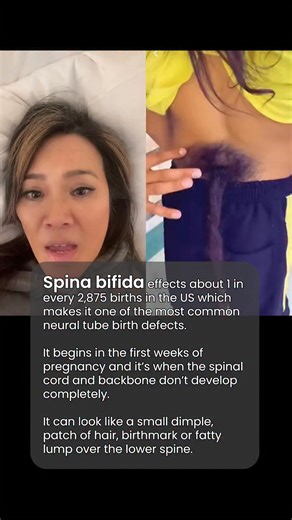 When a baby is born with spina bifida, early care is everything. 💙 The area is carefully protected, specialists step in, and imaging helps guide next steps - often including surgery - to protect the spinal cord and prevent complications. Sometimes even a small skin sign can be an important clue, which is why early evaluation matters so much. This could be spina bifida.. but I'm going to cry foul on the ponytail... #drpimplepopper #spinabifida #popaholics | Dr Sandra Lee aka drpimplepopper