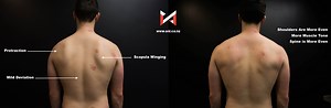 Winged Scapula and Shoulder Pain [Case Study] — ONI | Wellington Personal Training Studio
