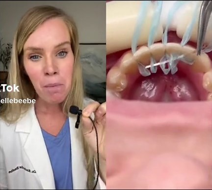 Putting a bonded retainer in place. #bondedretainer #retainer #PermanentRetainer #Orthodontist #Dentist #Fixed Retainer