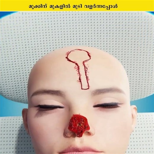 മൂക്കിന് മുകളിൽ മുടി വളർന്നപ്പോൾ #shorts