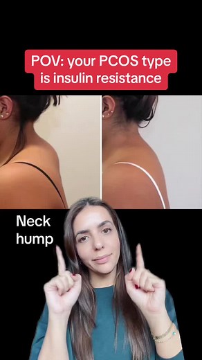 Understanding Insulin Resistance in PCOS Symptoms