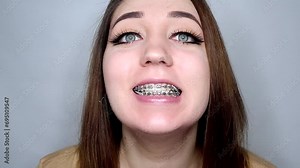 Elastics installed on braces, close-up. Beautiful woman points with finger at new elastics installed on braces by orthodontist doctor. Elastics help in orthodontic treatment with braces to align bite